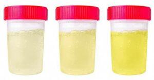 Πρόβλημα με το συκώτι όγκοι ή ουρολοίμωξη: 7 πράγματα που λένε τα ούρα ...