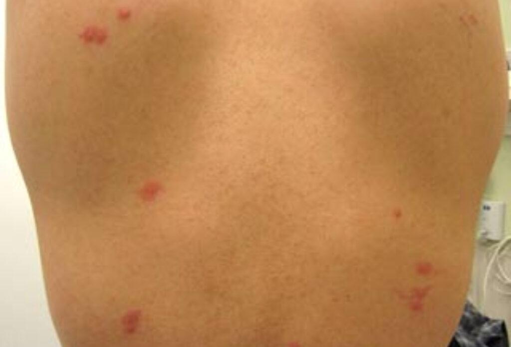 Κοριοί βαμπίρ: Πως είναι το τσίμπημα τους (φωτογραφίες) και πως να τους ...